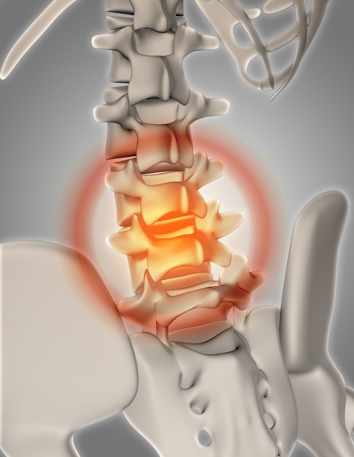 What is a Bulging Disc and The Top Treatment Options | Resilience ...